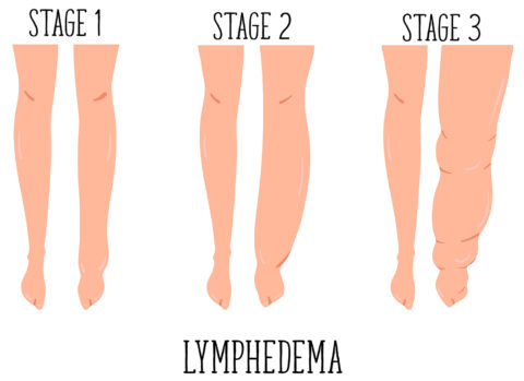 What is Lymphedema? | American Venous Forum