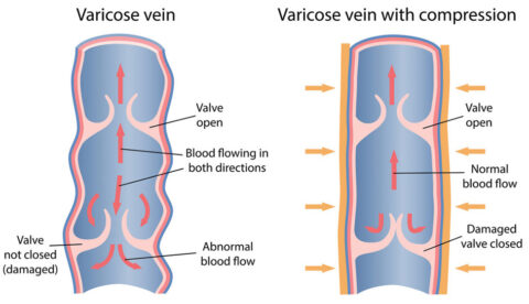 What is Vein Disease and Lymphedema? | American Venous Forum